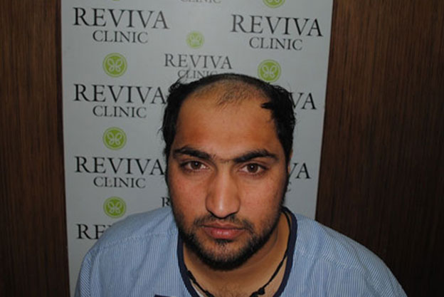 8 - Best Hair Transplant in India@Chandigarh, Reviva Clinic