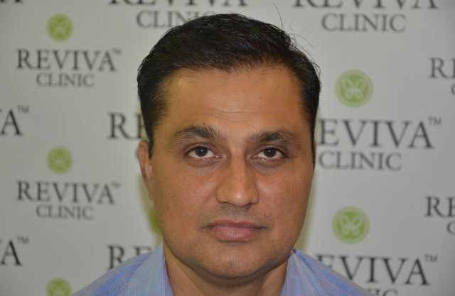 gents-after - Best Hair Transplant in India@Chandigarh, Reviva Clinic