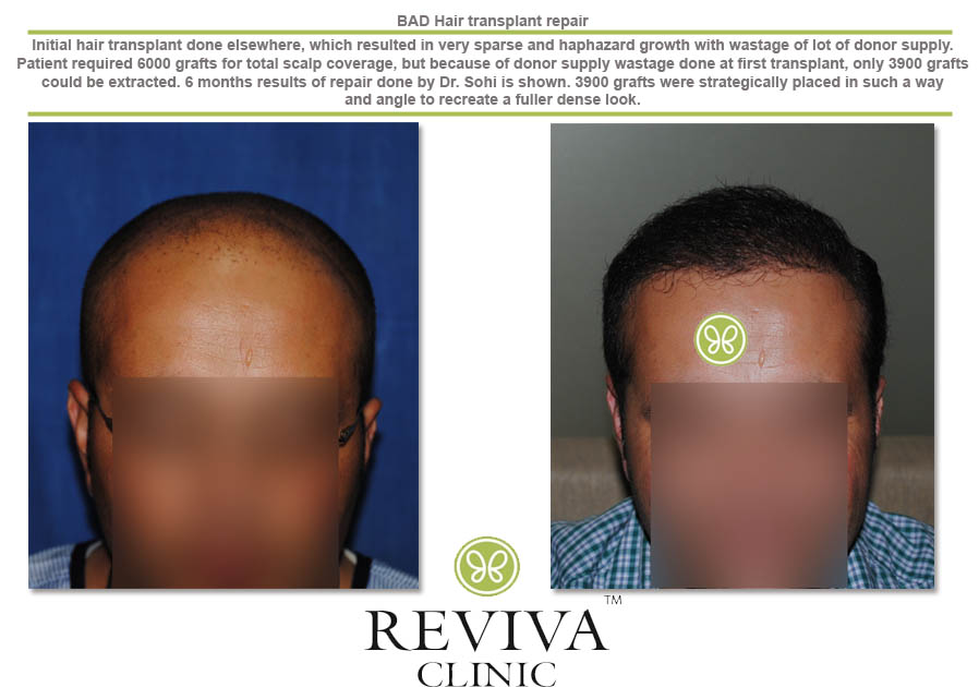 Hair Line | Hair Transplant Repair Surgery | Chandigarh | India ...
