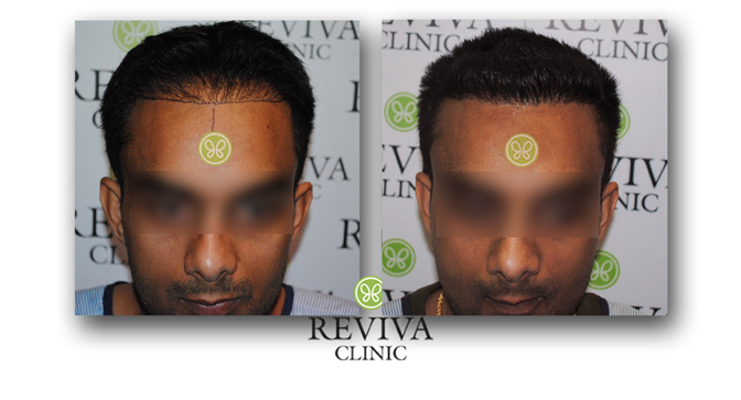 Hair Line | Hair Transplant Repair Surgery | Chandigarh | India ...
