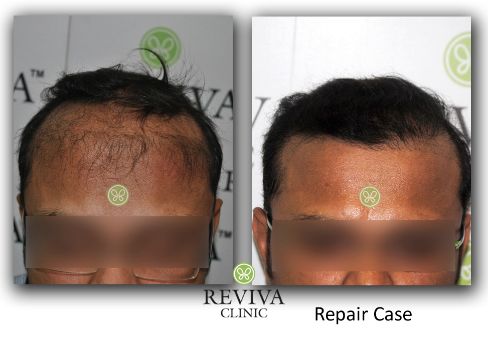 Hair Line | Hair Transplant Repair Surgery | Chandigarh | India ...