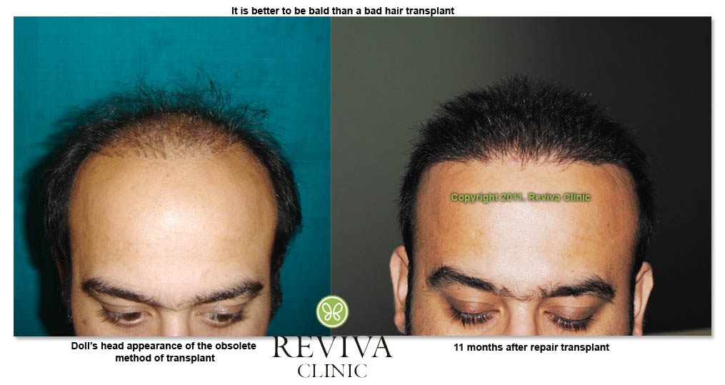 Hair Line | Hair Transplant Repair Surgery | Chandigarh | India ...