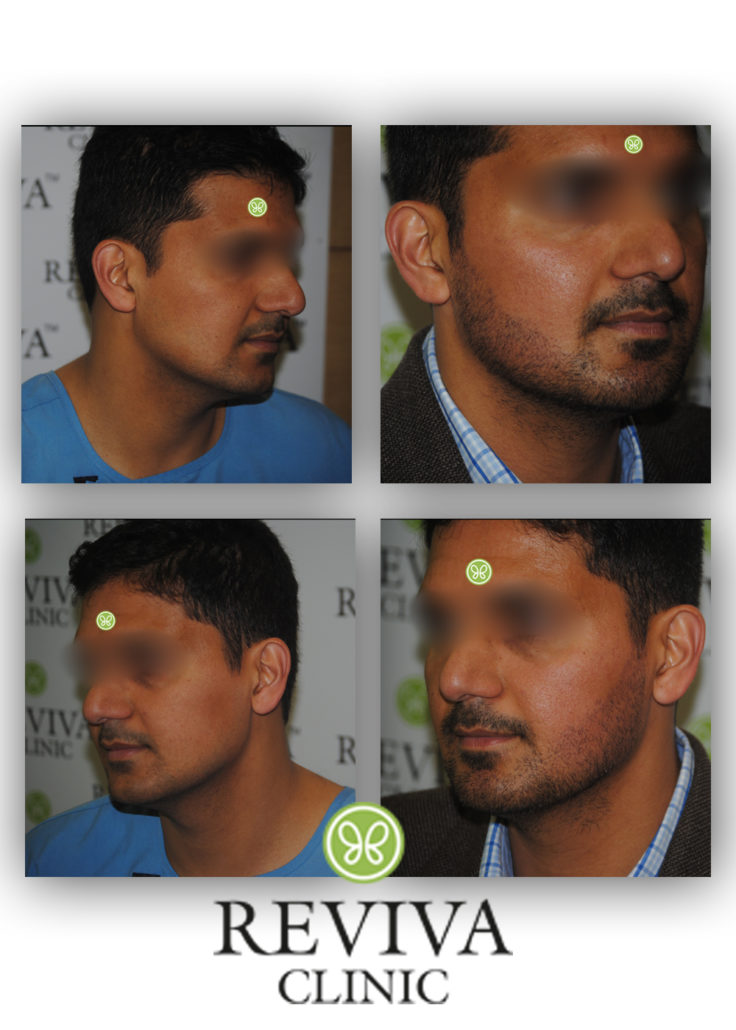 2 - Best Hair Transplant in India@Chandigarh, Reviva Clinic