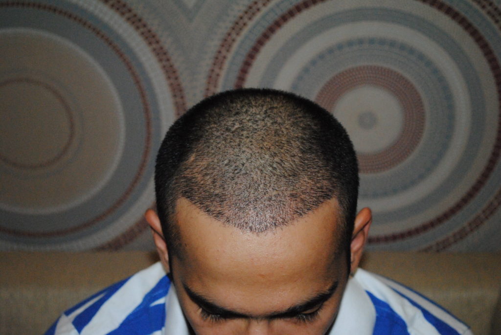 Hairline Artistry | Natural Looking Hairline| Hairline design | Reviva ...