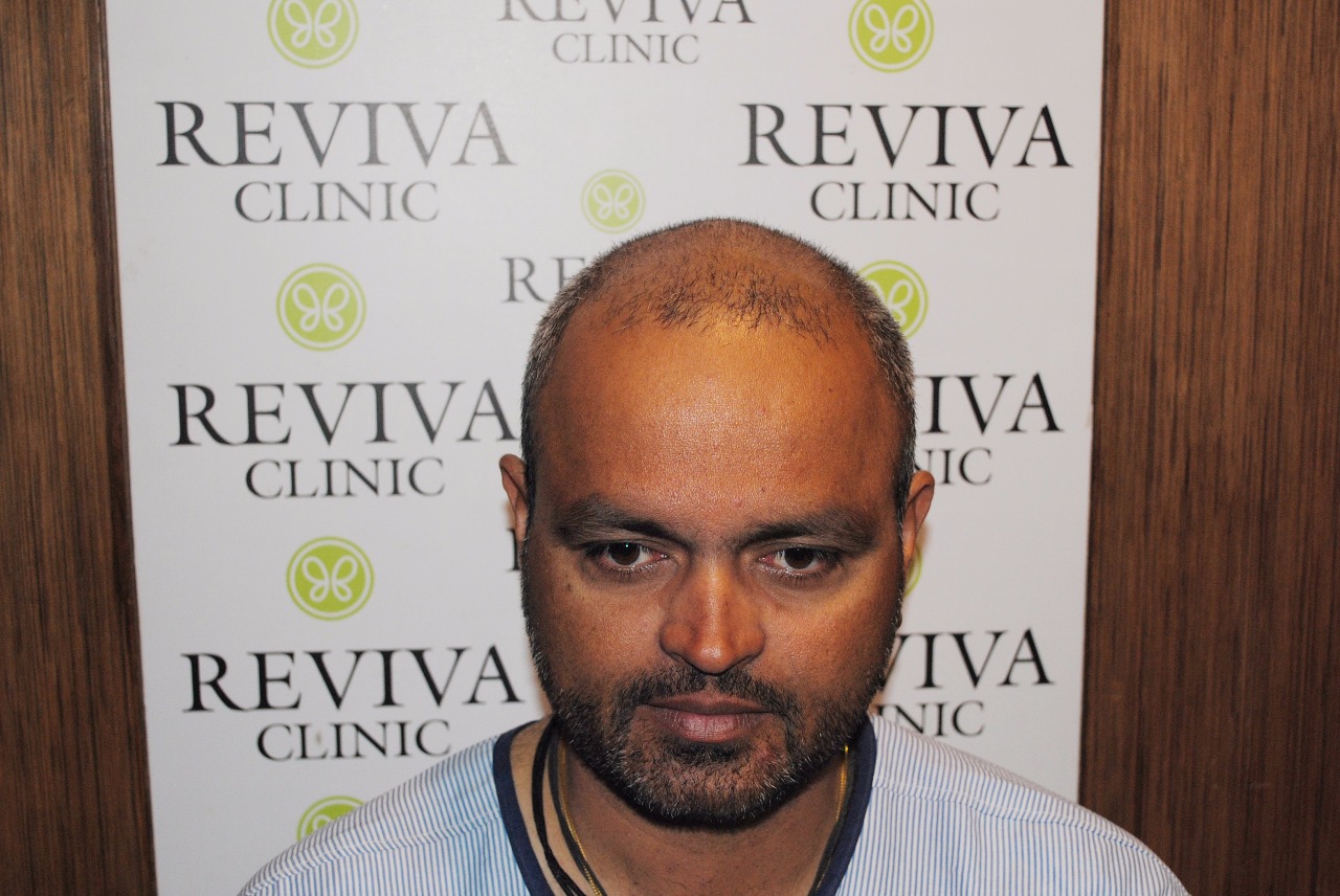 Gallery-new - Best Hair Transplant in India@Chandigarh, Reviva Clinic