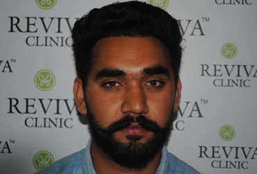 Gallery-new - Best Hair Transplant in India@Chandigarh, Reviva Clinic