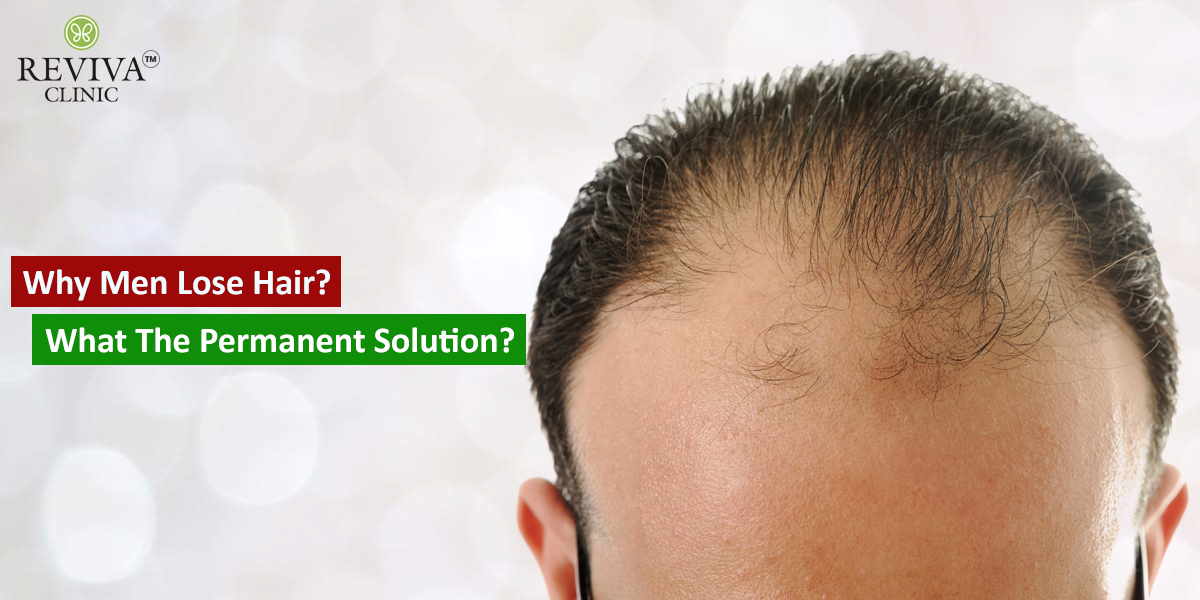 Why Men Lose Hair? What’s The Permanent Solution? - Best Hair ...